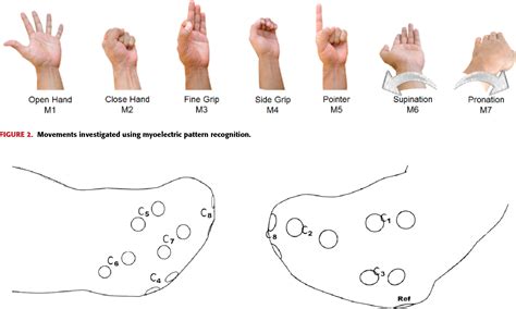 Dysmelia Semantic Scholar
