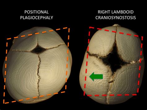 Positional Plagiocephaly — Dallas Pediatric Plastic Surgeon