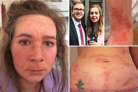 Horrific Reaction To Eczema Cream Leaves Womans Skin Peeling Off And