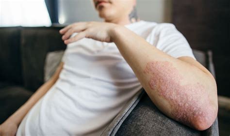 Four Triggers For Psoriasis Symptoms And How To Treat It Uk