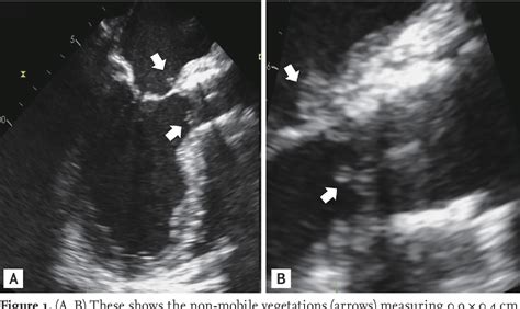 Figure 1 From Acute St Elevation Myocardial Infarction Due To