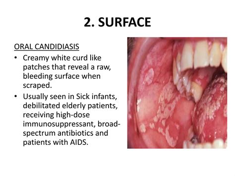 The Tongue In Health And Sicknesspptx