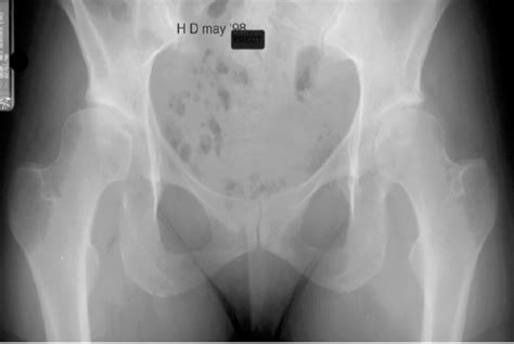 Bilateral Acetabular Dysplasia In 17 Years Old Patient Download