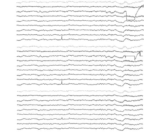 a the same eeg artifact as in fig 7 b before cr rejection