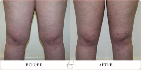 Knees Calves Ankles Vaser Liposuction Before After