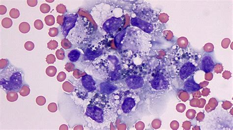 Images Tagged Csf Eclinpath