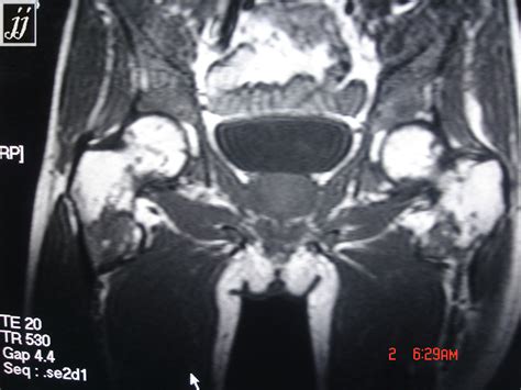 Bone Metastatic Lesion Radiopaedia