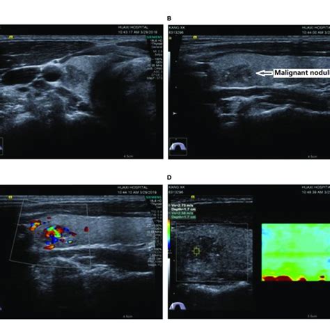 Ultrasound Showed A Solid Hypoechoic And Irregularly Shaped Nodule 13 Download Scientific