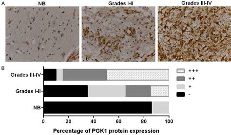 Figure 1 From Phosphoglycerate Kinase 1 Gene Knockdown Suppresses The