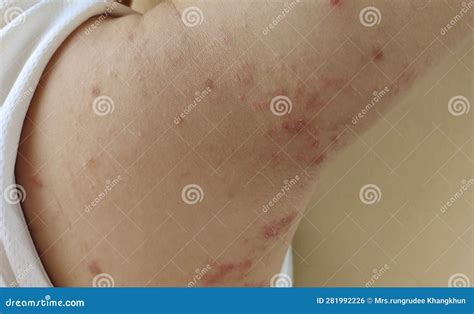 The Chronic Dermatitis Rash Hives Allergy And Peeling Skin Stock