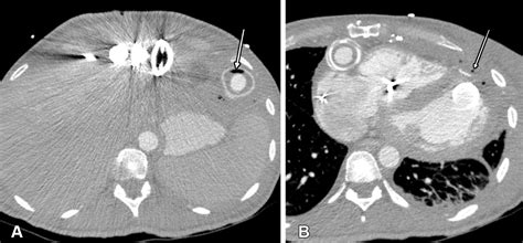 Left Ventricular Assist Devices Advances Complications And Pitfalls