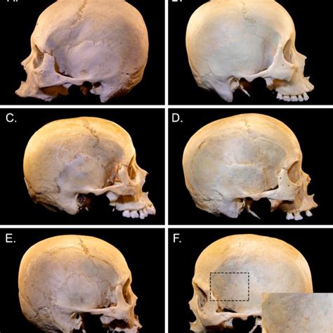 Classification Of Pterion Patterns And Their Prevalence By Sex And