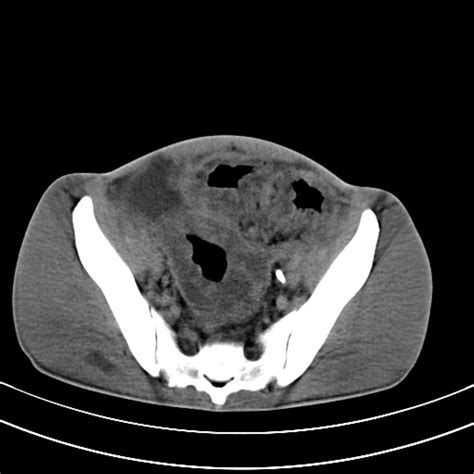 Ulcerative Colitis Radiozen