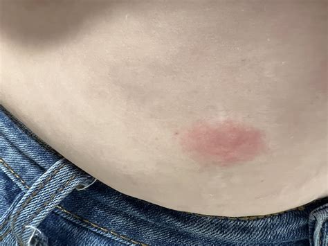 Injection Site Irritation Rozempic