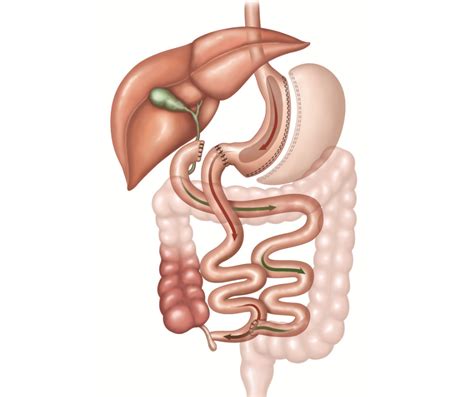 Biliopancreatic Diversion Surgery Withwithout Duodenal Switch Bpdds