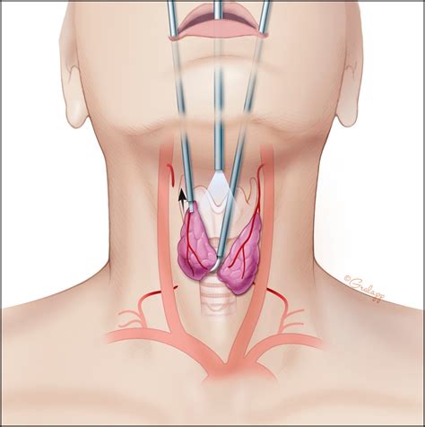 Parathyroid Surgery Scar