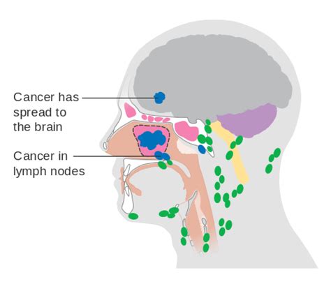 Maxillary Sinus Carcinoma