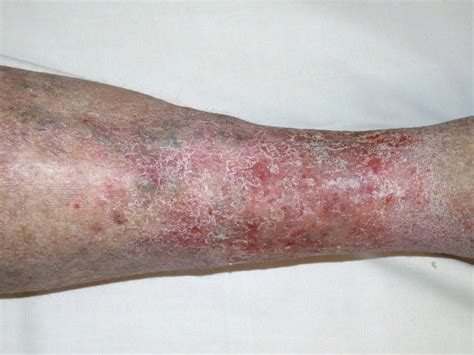 Stasis Dermatitis In Older Adults Treatment Options