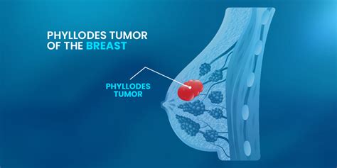 Phyllodes Tumor Of The Breast Overview Symptoms And Treatment