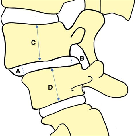 Measurement Method Of Intervertebral Disc Height Index A Bc D