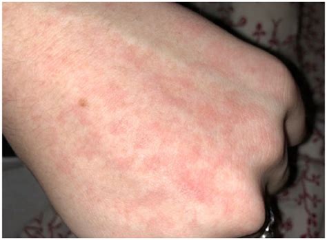 Amoxicillin Ebv Rash