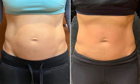 Evolve X Non Surgical Body Contouring Bella Vista Nsw