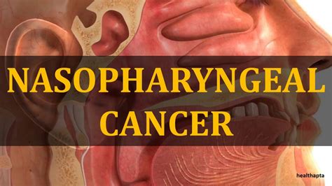 Symptoms Of Nasopharyngeal Cancer Np Screen