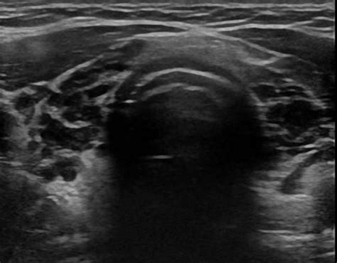 Head And Neck 4 1 Thyroid Gland Case 4 1 4 Thyroiditis And Diffuse