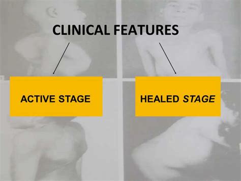 Potts Spine Tuberculosis Spine Pptx Pptx