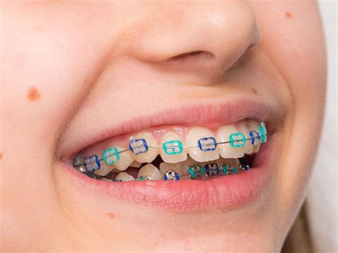 Aparat Dentar Pret Metalic Sau Invizibil In 2021 Plata In Rate