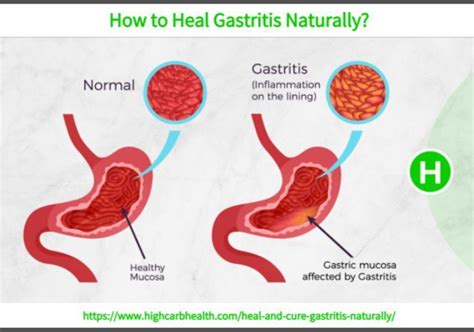 Gastritis Causes Symptoms Diagnosed Treatment And Healing Artofit