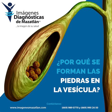 Por Que Se Producen Las Piedras En La Vesicula Form Example Download