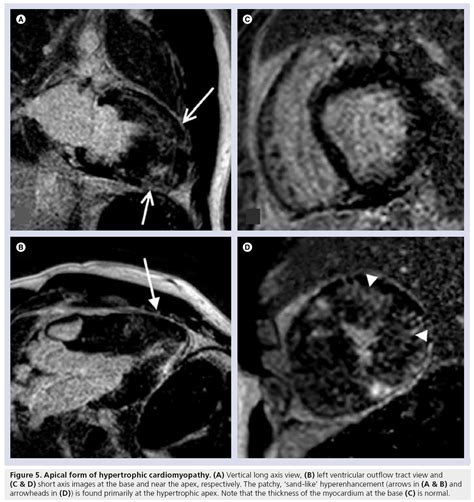 Delayed Enhancement Cardiac Mri In The Evaluation Of Cardiomyopat