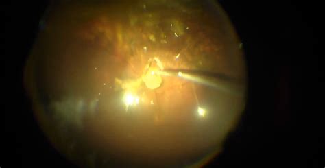 Complex Repair Of Combined Tractionalrhegmatogenous Retinal Detachment