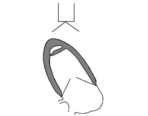Right Ventricular Inflow Tract View Quiz