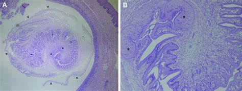 Taenia Solium Cisticercus Cellulosae