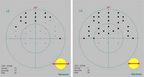 How To Fail Visual Field Test For Blepharoplasty Capa Learning