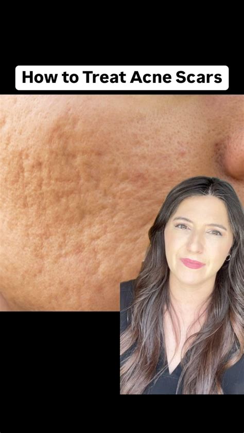 Best 14 Scar Removal Treatment In Delhi Scar Removal Results Before
