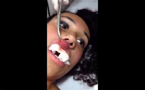 ამ გოგონამ ზედა ტუჩზე პლასტიკური ოპერაცია გაიკეთა და სულ რამდენიმე დღეი დაუსივდა ექიმთან მივიდა