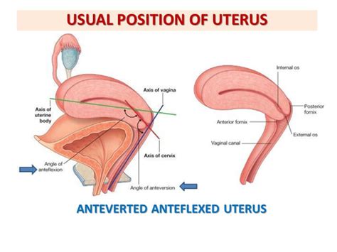 Retroverted Uterus Cervix Position