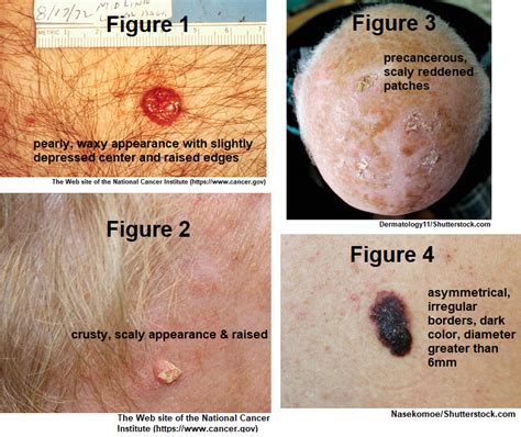 Squamous Cell Carcinoma Skin Cancer Photos Cancerwalls