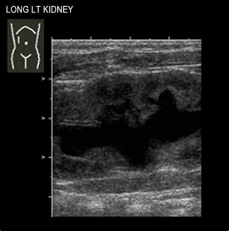 Samples Learning The Sfu Method To Grade Hydronephrosis Cevl For