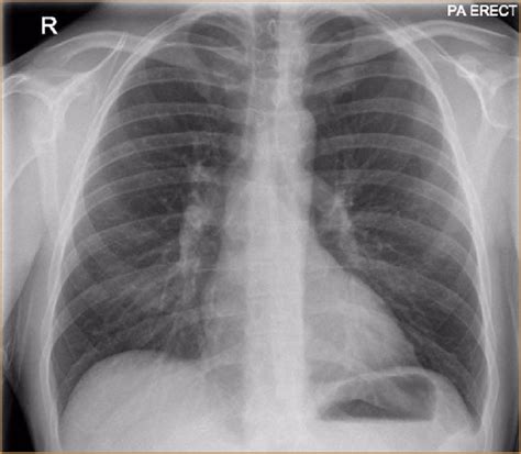 Needle Aspiration For Pneumothorax At Kari Gonzales Blog