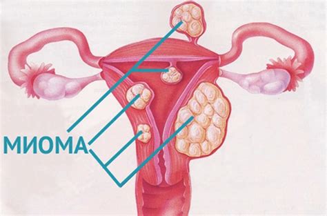 Миома матки