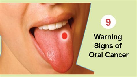 Mouth Cancer Symptoms Warning Signs