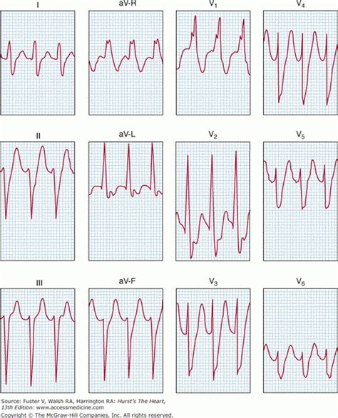 Supraventricular Tachycardia Atrioventricular Nodal Reentry And Wolff