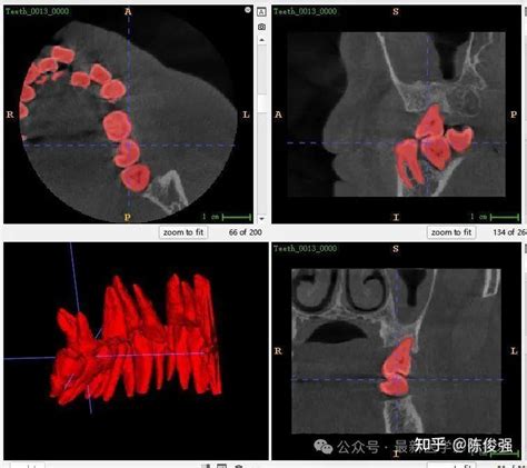 Sts3d2023——sts 基于3d Cbct的牙齿分割任务 知乎