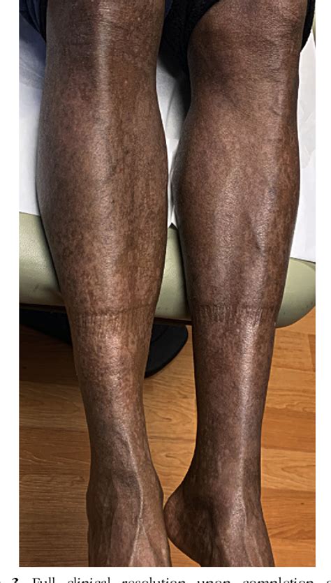 Figure 3 From Onset Of Rupioid Psoriasis After Vasodilatory Regimen Initiation In A Patient With