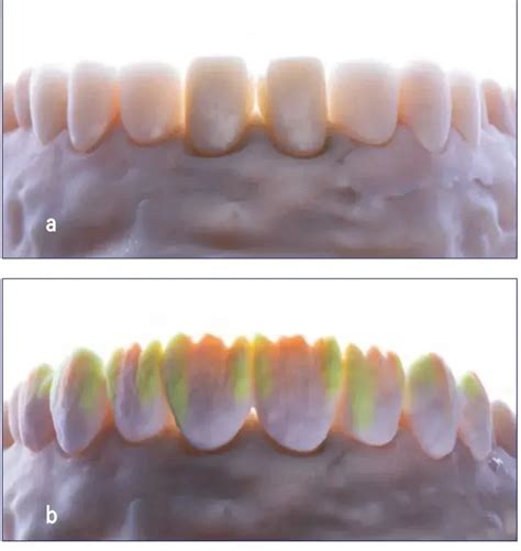 Mira A 10‑step Minimally Invasive Restorative Protocol