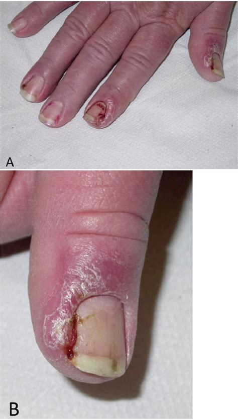 Excess Granulation Tissue And Hair Loss Following Acitretin Pmc